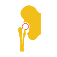 Hip Replacement | Cemplicity